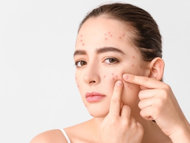 How To Address Acne, With or Without a Dermatologist’s Assistance ...