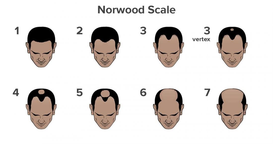 Can you fix a receding hairline? - Aglow Dermatology