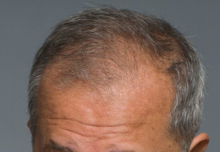 Can you fix a receding hairline? - Aglow Dermatology