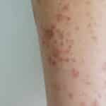 How do I get Rid of Bed Bug Bites