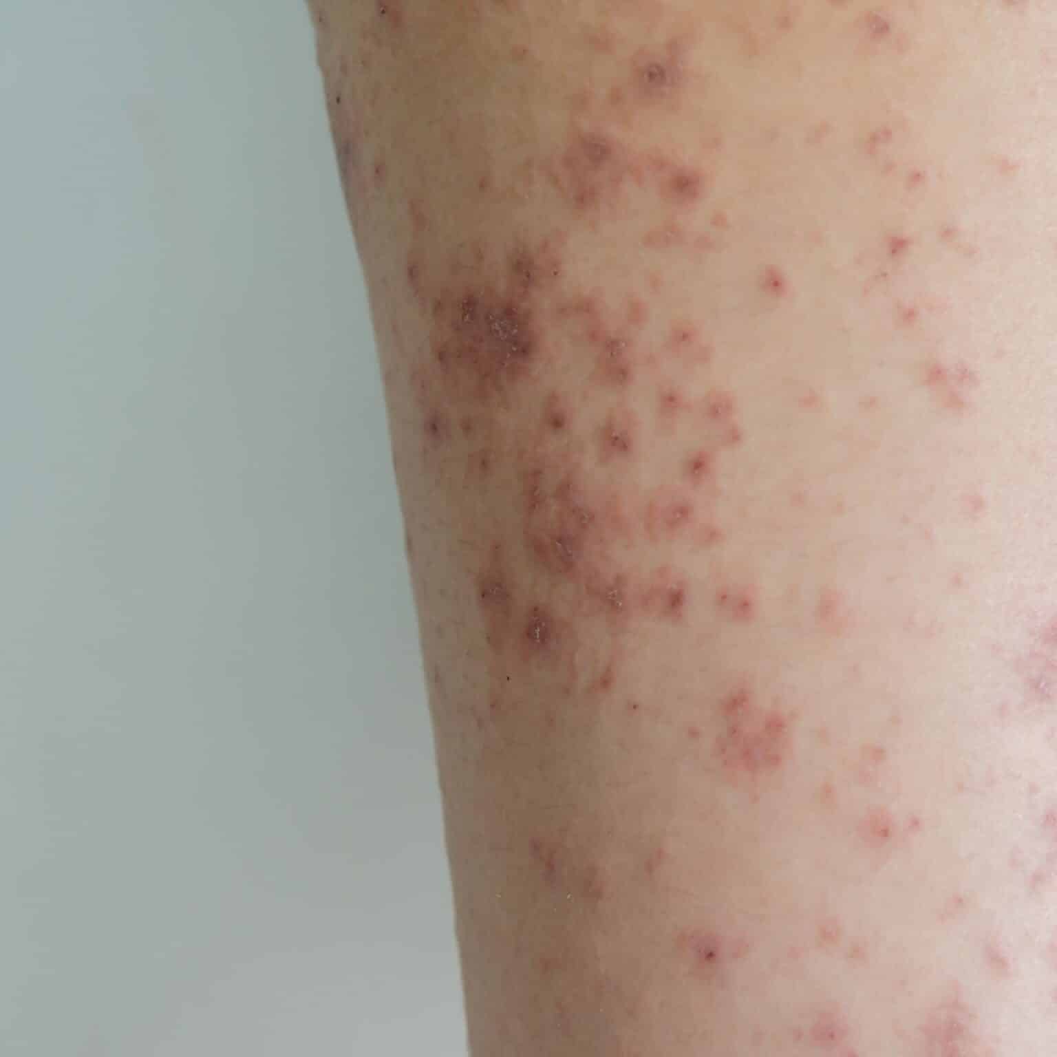 How do I get Rid of Bed Bug Bites