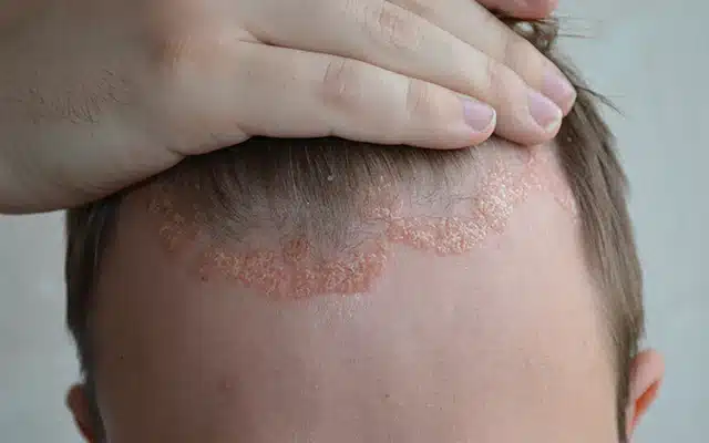 Scalp psoriasis plaques vs other scalp conditions