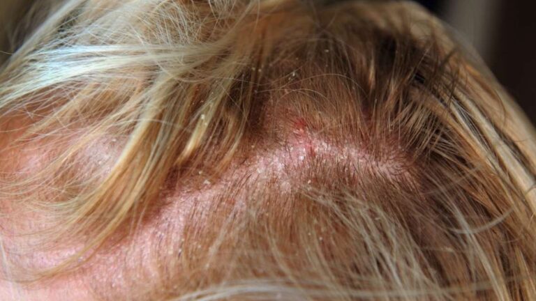 Scalp psoriasis plaques vs other scalp conditions