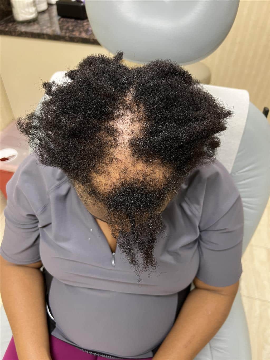 Metformin and Hair Loss: What You Need to Know - Aglow Dermatology