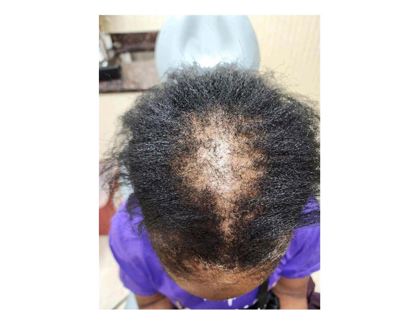 Central Centrifugal Cicatricial Alopecia (CCCA) - Aglow Dermatology
