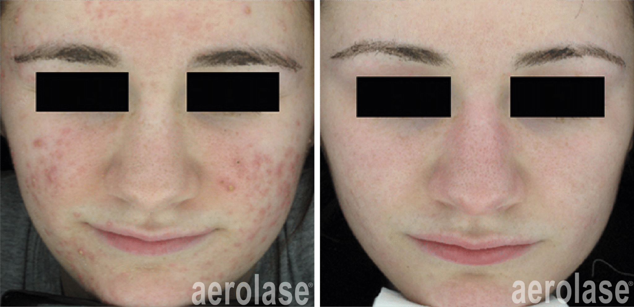 NeoClear Acne Treatment NYC - Aglow Dermatology