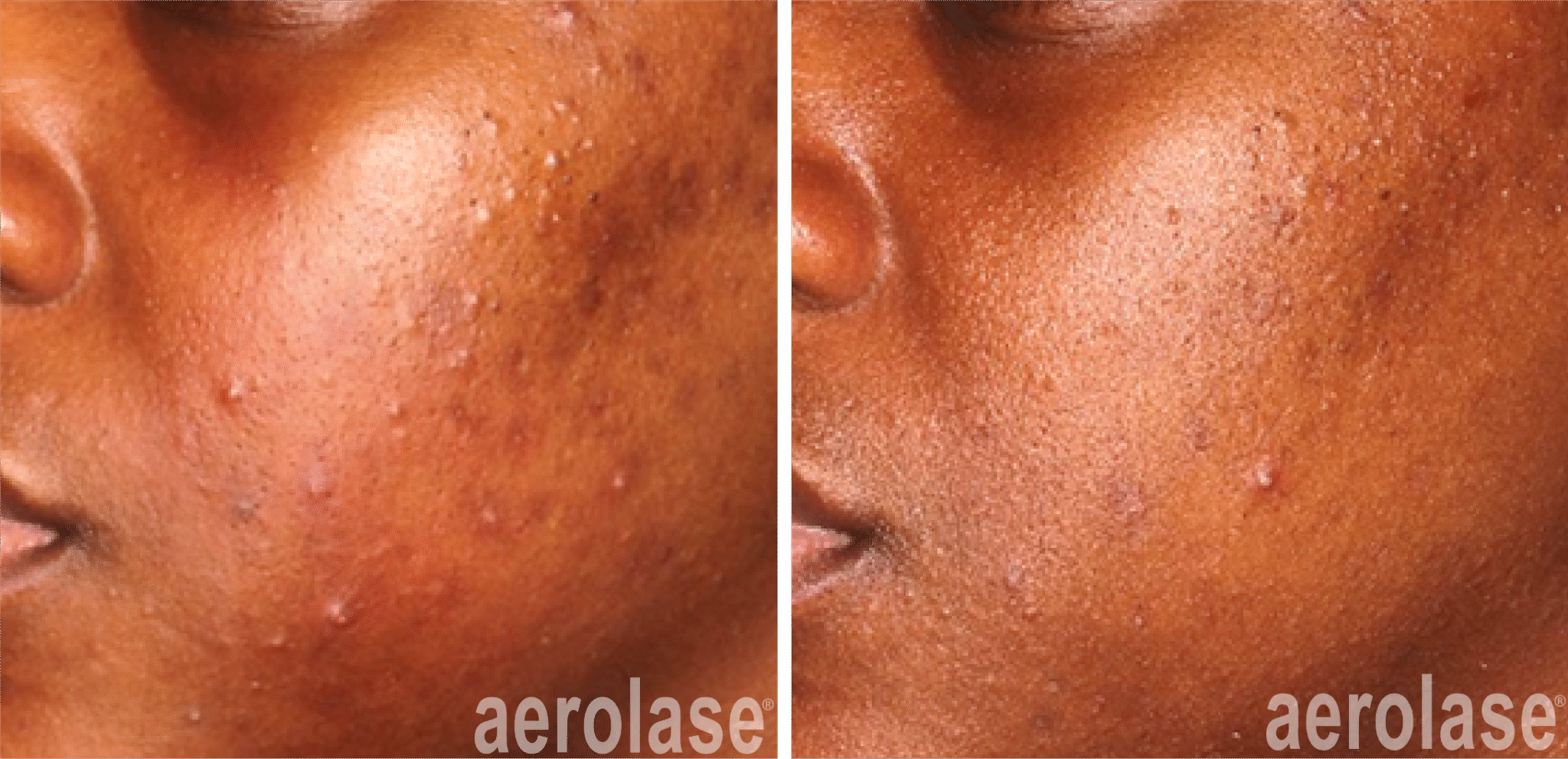 NeoClear Acne Treatment NYC - Aglow Dermatology