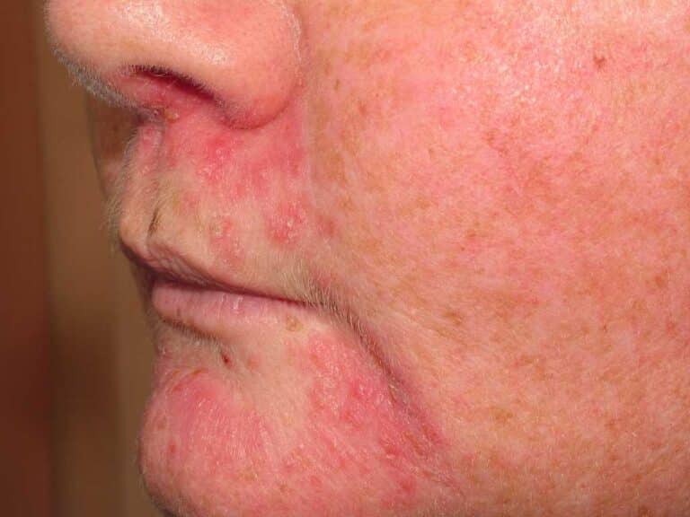 Dermatologist for Perioral Dermatitis - Aglow Dermatology